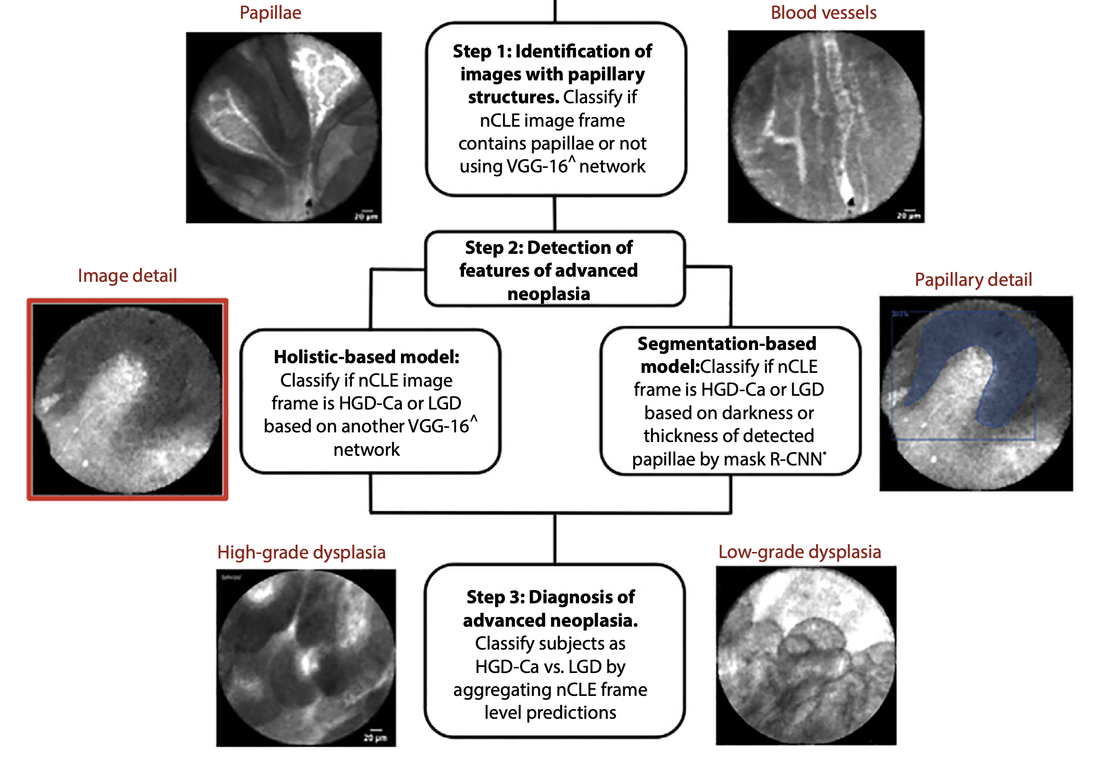 266 COMPUTER-AIDED DETECTION OF ADVANCED NEOPLASIA IN INTRADUCTAL ...